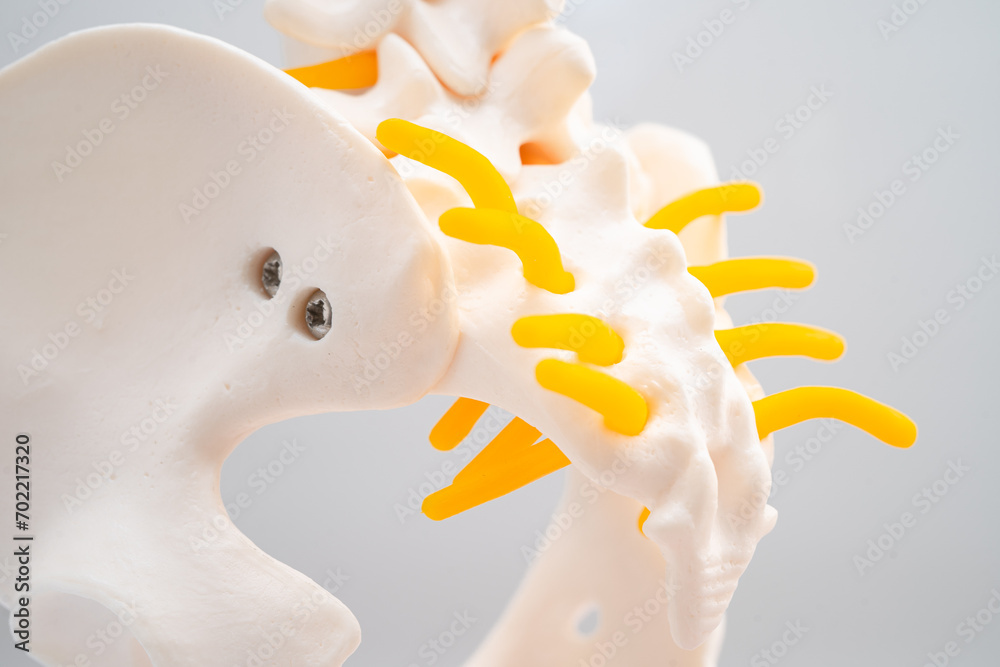 Lumbar spine displaced herniated disc fragment, spinal nerve and bone ...