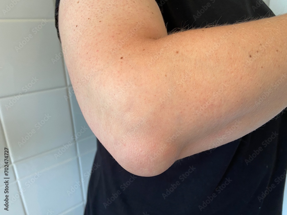 Foto de Stock olecranon bursitis is sometimes called “Popeye’s elbow ...
