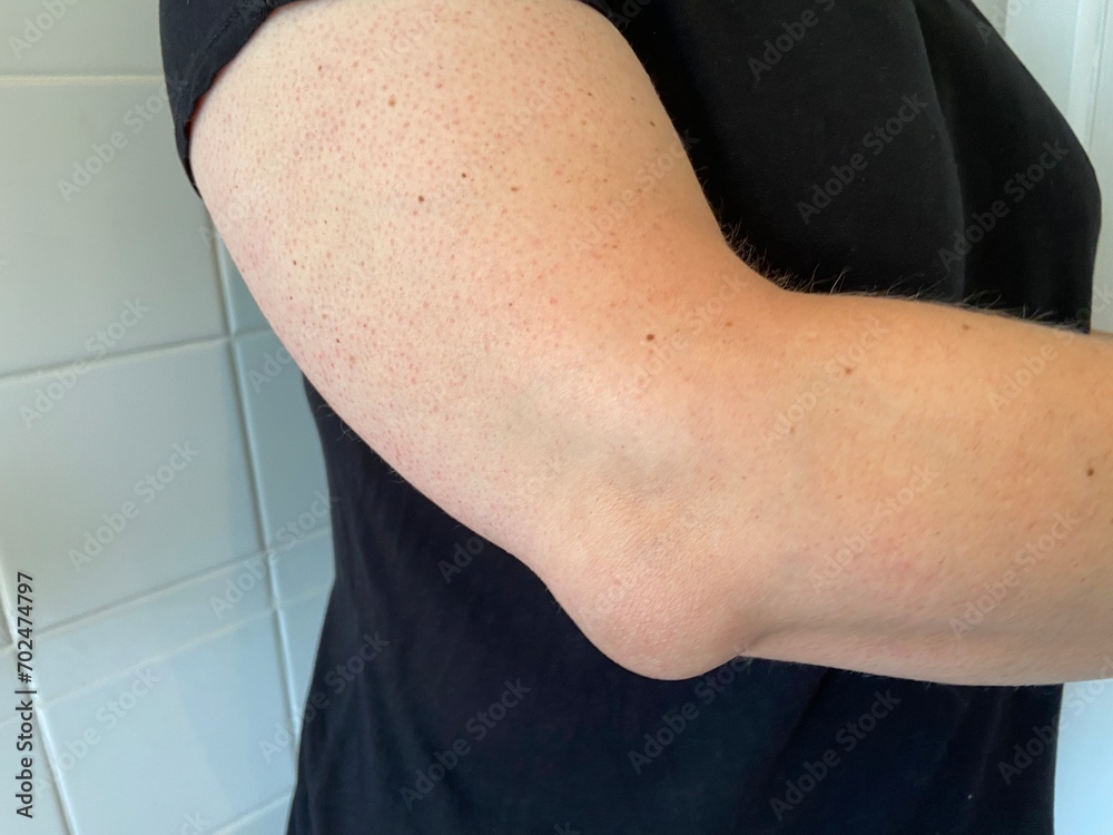 olecranon bursitis is sometimes called “Popeye’s elbow.” Bursitis is a ...