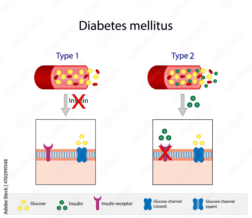 Diabetes mellitus type 1, pancreas's failure to produce enough insulin ...