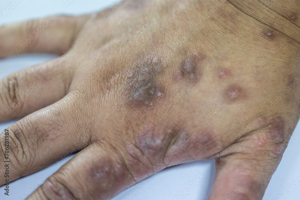 Atopic dermatitis (AD), also known as atopic eczema, is a type of ...