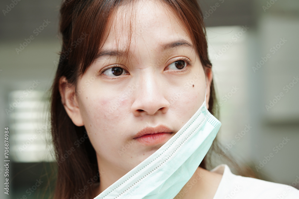 Acne pimple and scar on skin face, disorders of sebaceous glands ...