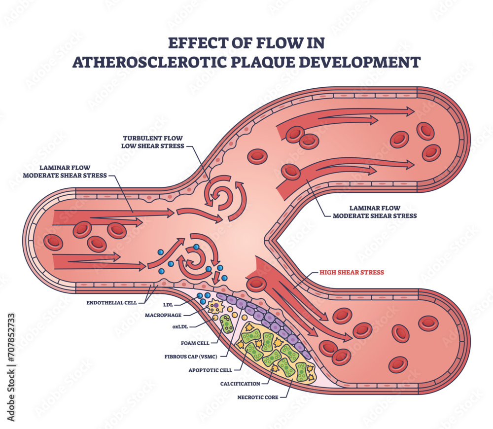 Effect of flow in atherosclerotic plaque development outline diagram ...