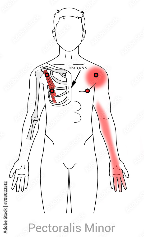 Pectoralis Minor Pain: Myofascial trigger points and associated pain ...
