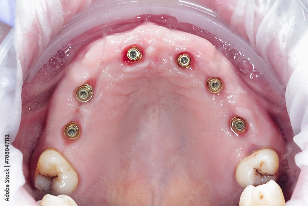 Screwed dental implants in the jaw. Concept of modern procedure in ...