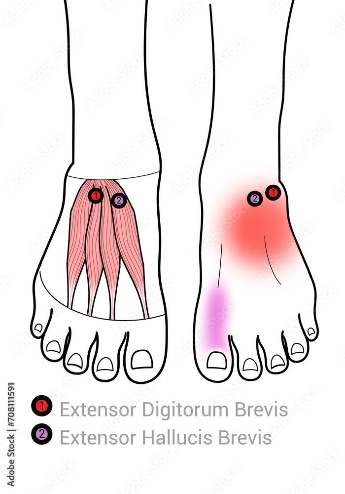 Extensor Digitorum Brevis and Extensor Hallucis Brevis: Myofascial ...