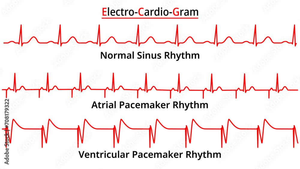 Vetor Set of ECG Common Abnormalities - Atrial vs Ventricular Pacemaker ...