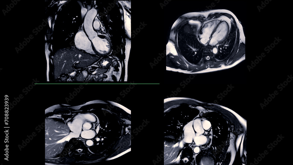 Cardiac MRI images are instrumental in assessing cardiac health ...