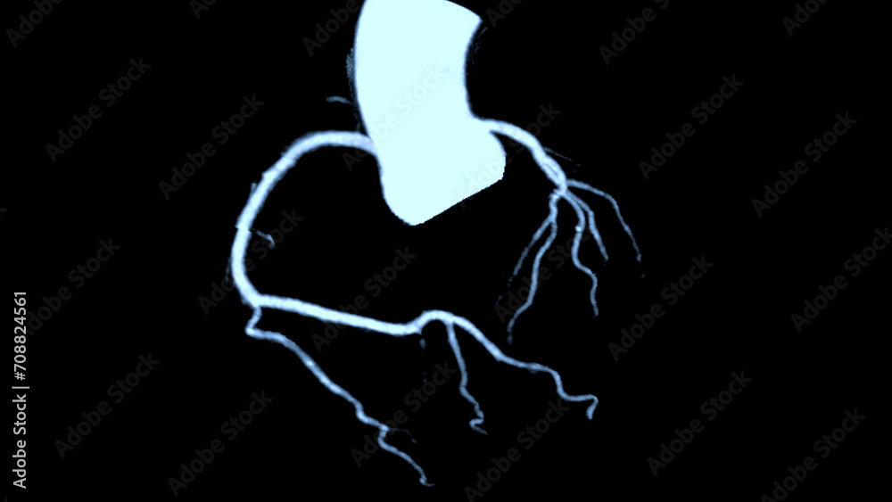 CTA coronary artery 3D rendering is a diagnostic imaging technique ...