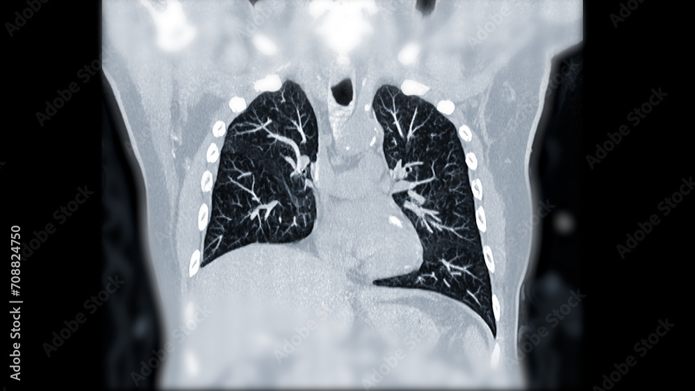 Stock-Illustration „CTPA or CTA pulmonary artery .This imaging ...