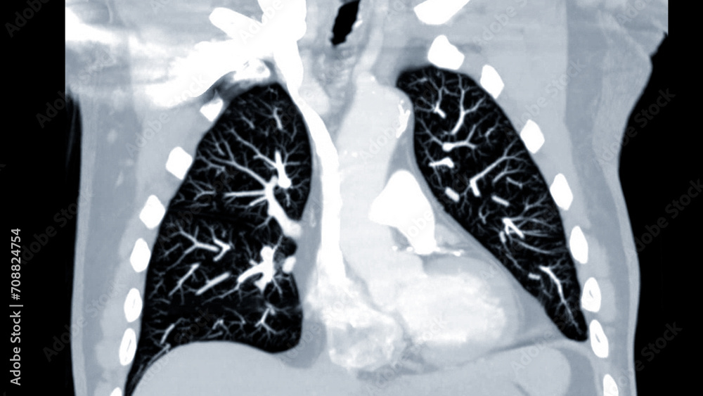 CTPA or CTA pulmonary artery .This imaging technique offers a clear ...