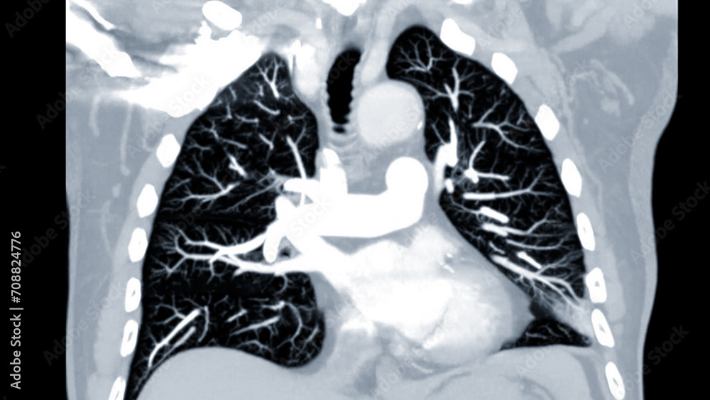 CTPA or CTA pulmonary artery .This imaging technique offers a clear ...