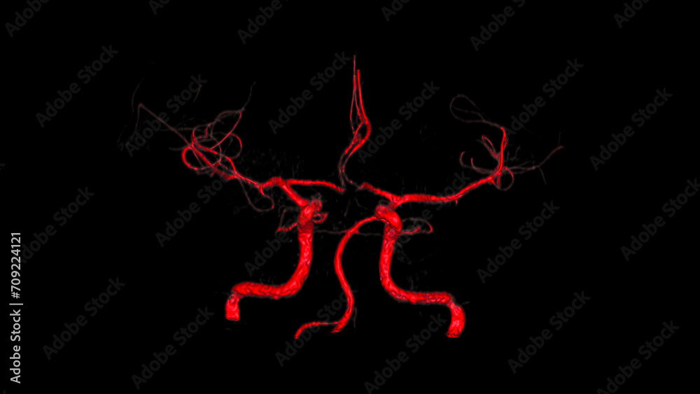 3d Reconstruction Of Angiographic Data Obtained By Simple Brain Mri Shows The Configuration Of