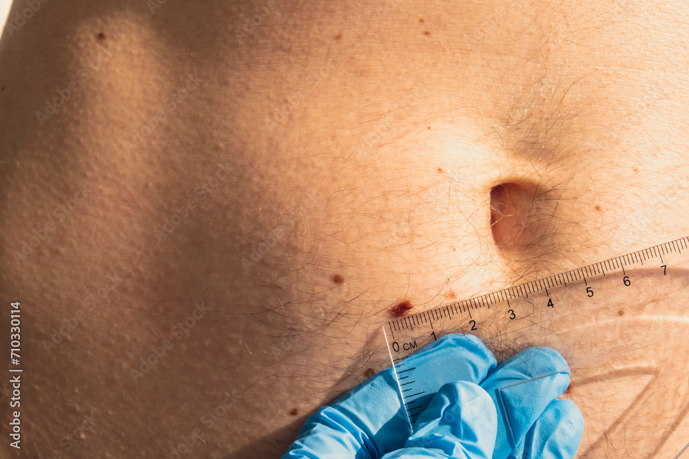 Dermatologist checking sizes of male birthmarks with ruler. Doctor ...