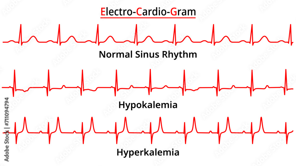 Set of ECG Common Abnormalities - Hyperkalemia - Hypokalemia ...