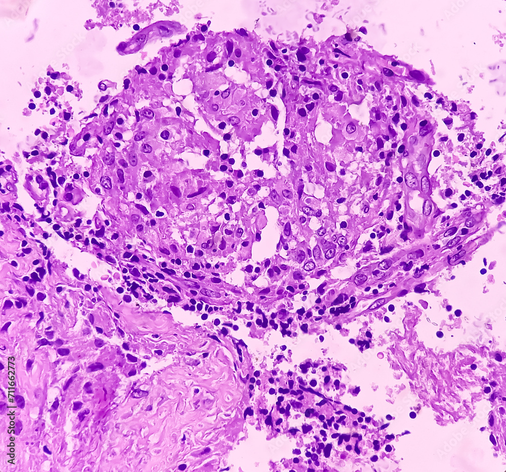 Thyroid cancer: Microscopic image of Follicular neoplasm. Malignant ...