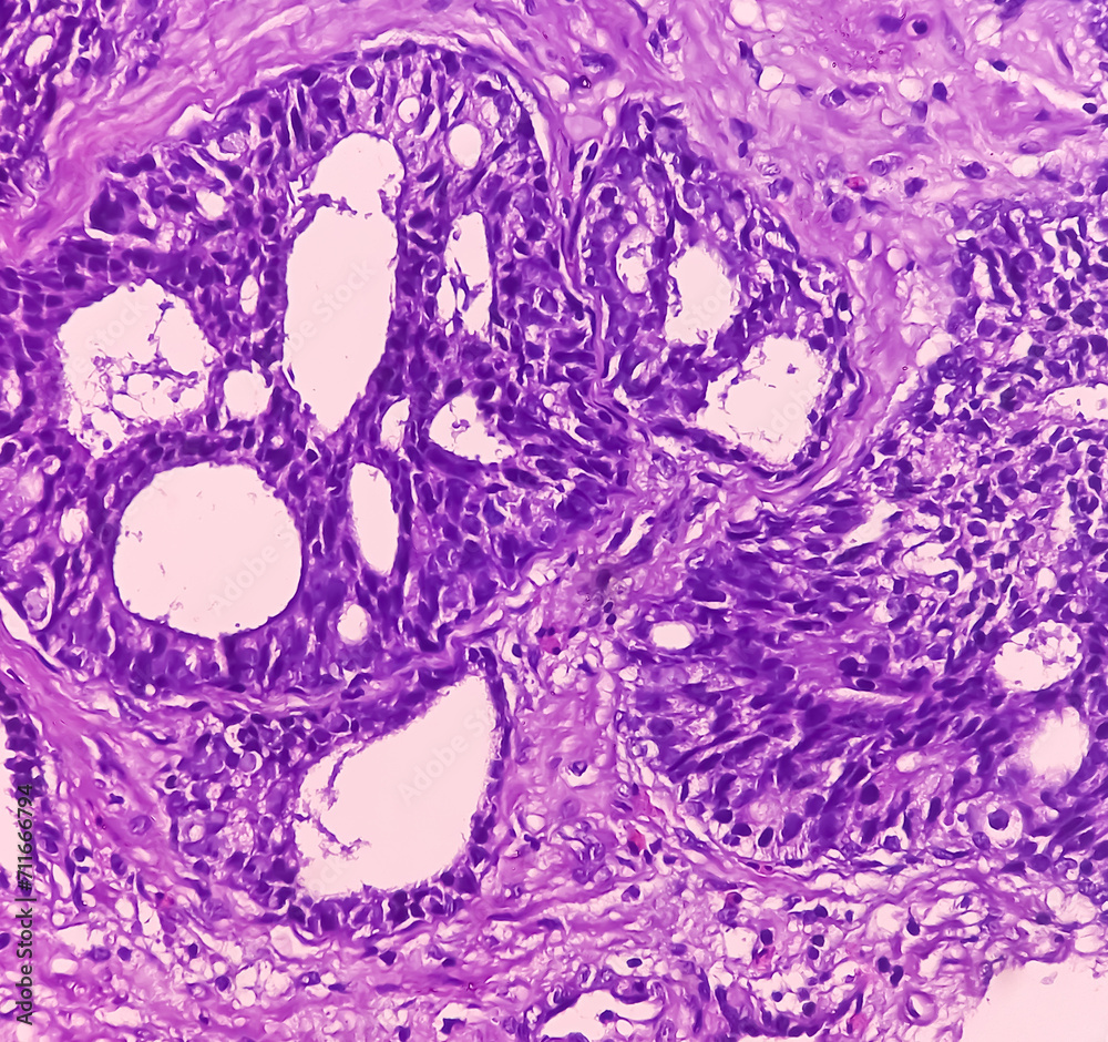 Prostatic chips (TURP): Adenocarcinoma. Sections show core of prostatic ...