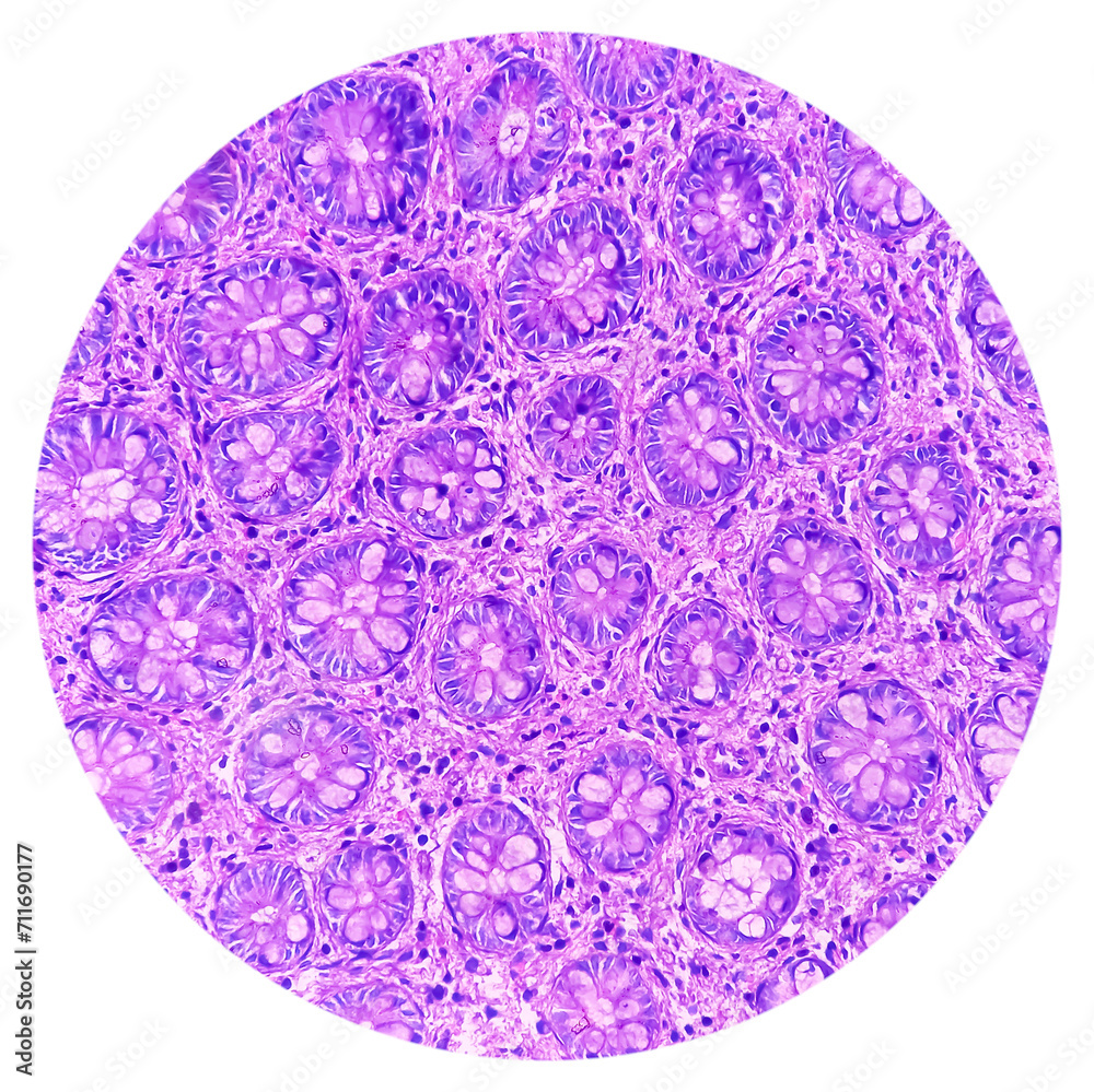 Ileo-cecal ulcer (biopsy): Chronic nonspecific ileitis with ulcer ...