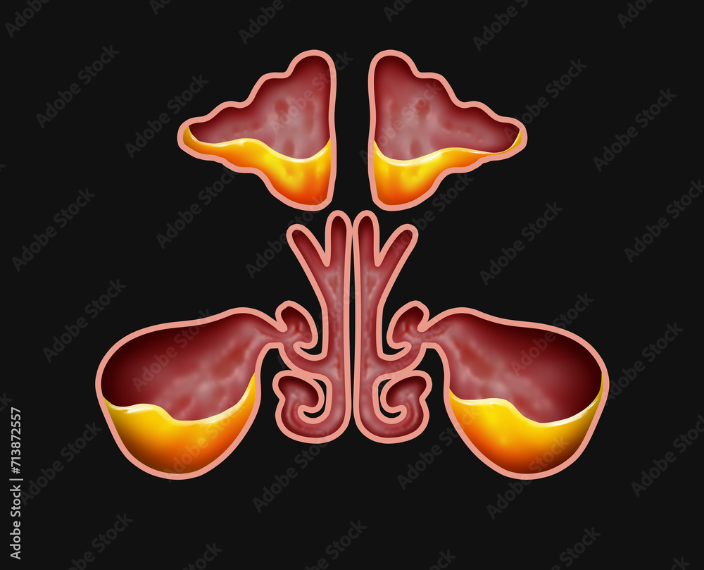 Sinusitis and Sinus Infection illness as a nasal congestion as a cavity ...