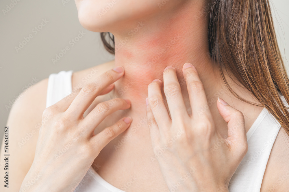 Stock-Foto „Dermatology concept, asian young woman, girl allergy ...