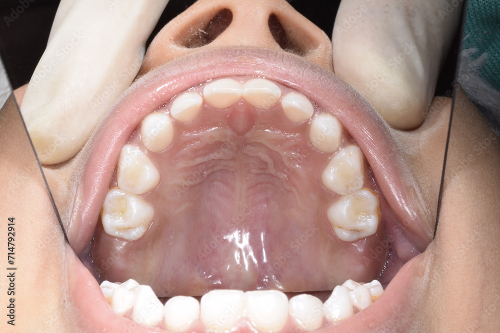 Upper maxillary arch occlusal indirect mirror view of a eight year old ...