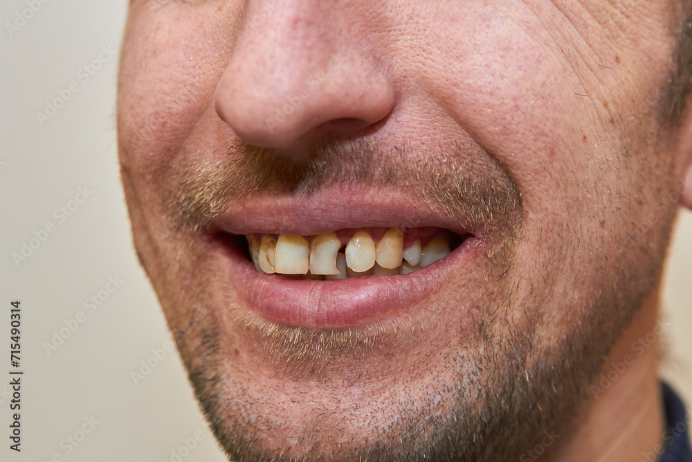 smile with a broken tooth close-up, man with stubble smiling with open ...