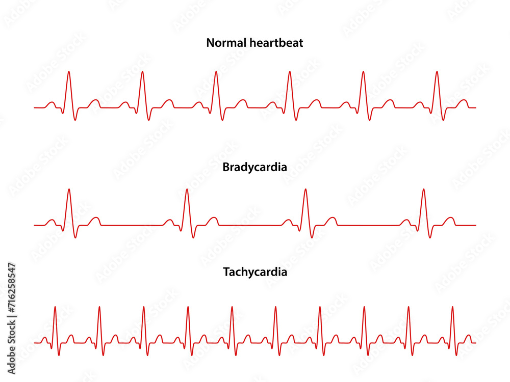 Diagram of normal rhythm, Tachycardia and Bradycardia for a human heart ...