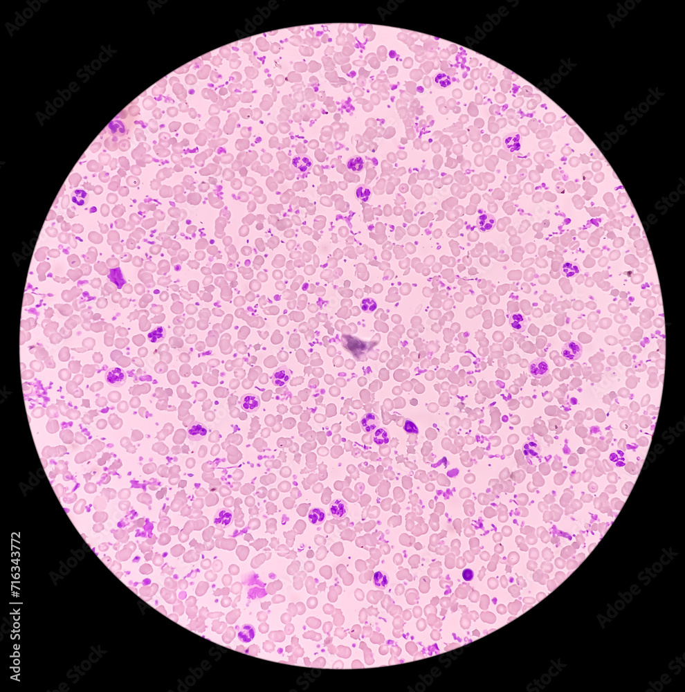 Essential thrombocytosis blood smear showing abnormal high volume of ...