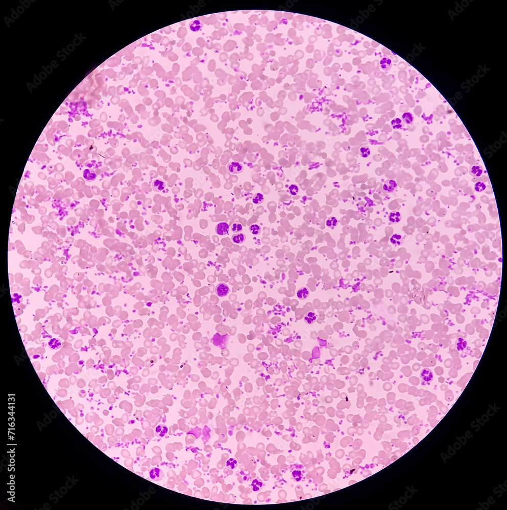 Essential thrombocytosis blood smear showing abnormal high volume of ...