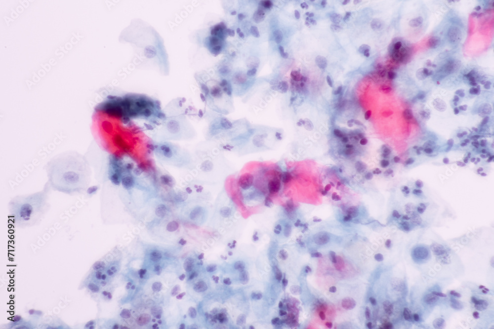 Abnormal squamous epithelial cells view in microscopy.Humanpapilloma ...