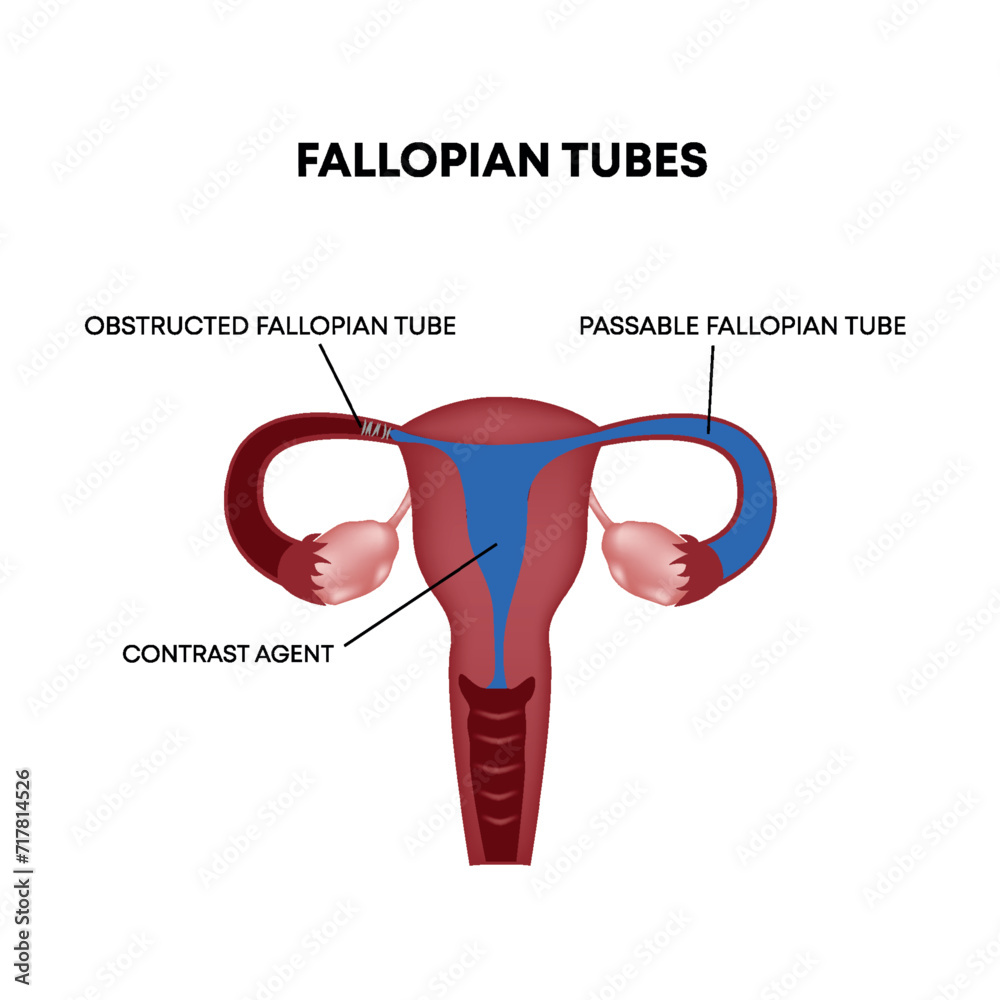 Checking The Patency Of The Fallopian Tubes Female Reproductive System