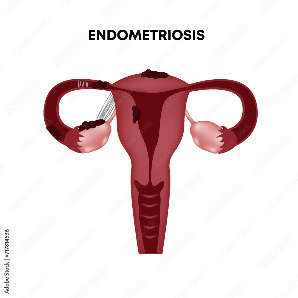 Stock-Vektorgrafik „Endometriosis and adhesions. Female reproductive system. Vector illustration ...