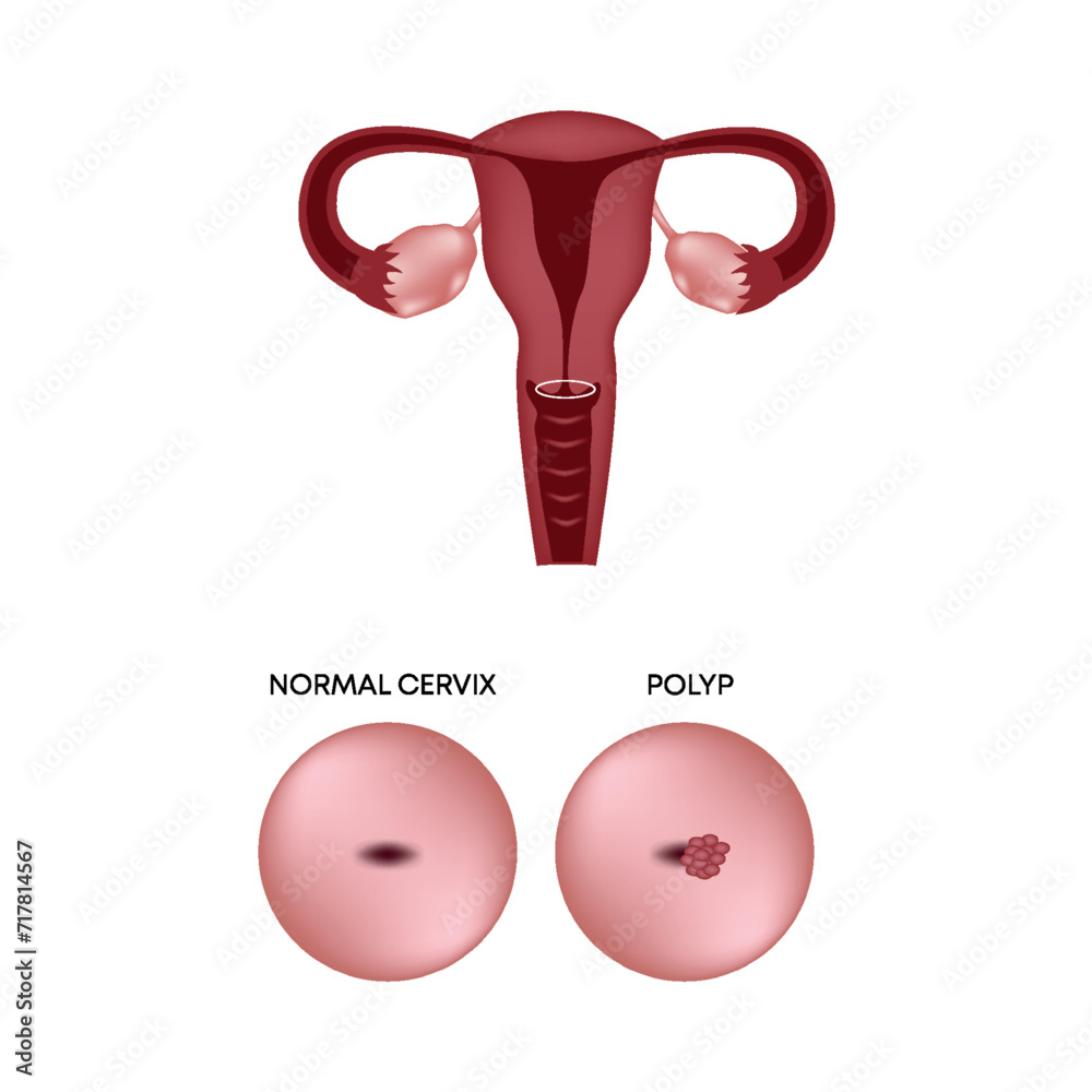 Uterus and cervix healthy and cervix with polyp. Female reproductive system. Vector illustration ...