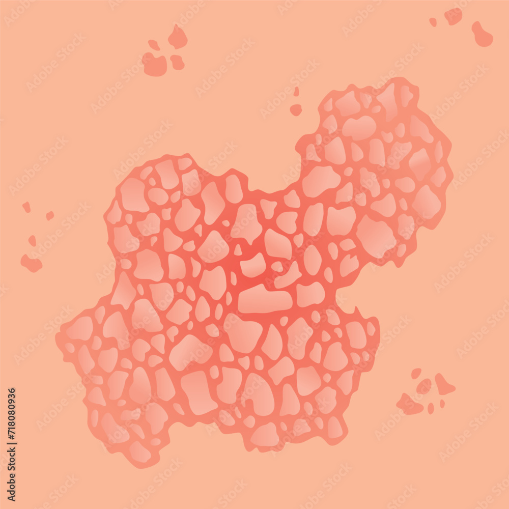 Type of psoriasis vector. Part of patients skin with dermatitis ...