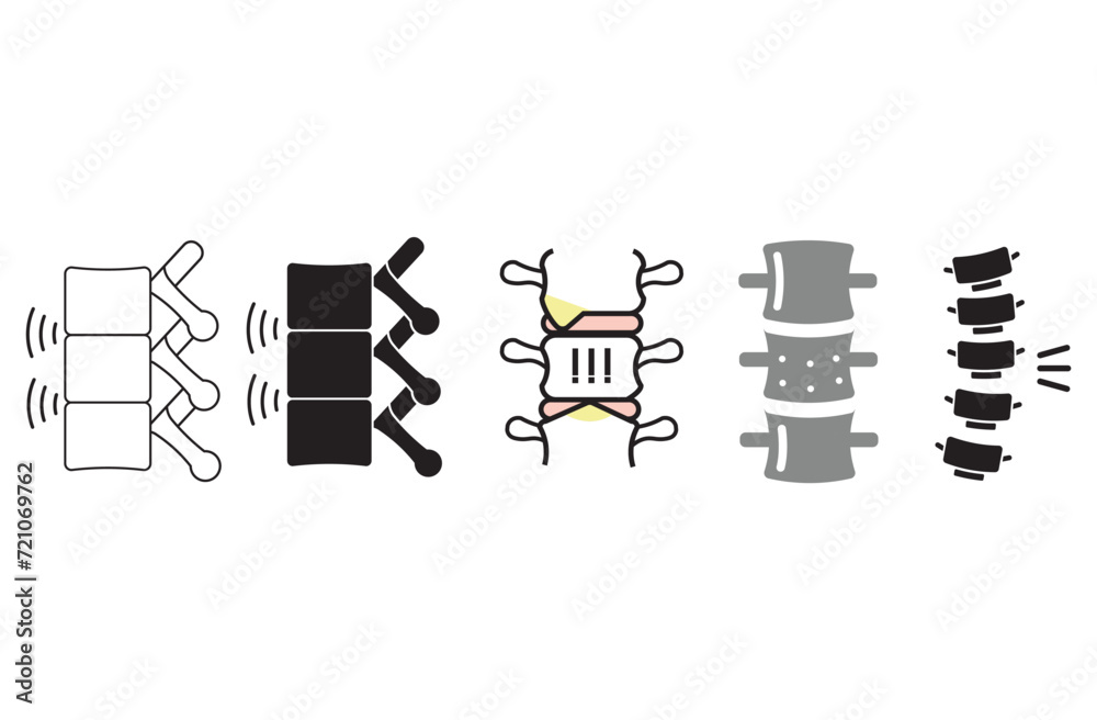 ankylosing spondylitis,Ankylosing spondylitis as inflammatory spine ...