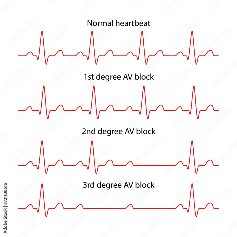 Diagram of normal rhythm and AV block for a human heart. Heart ...