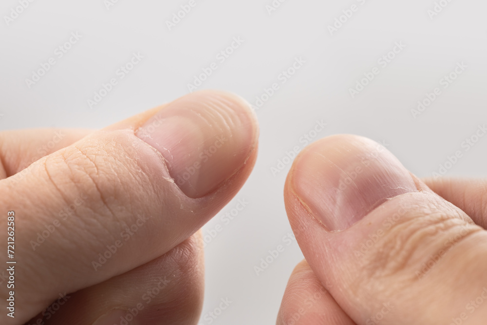 Ridged fingernails with vertical and horizontal ridges. Nails problems ...