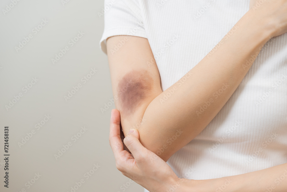 Close up of stain bruise wound on her arm, contusion asian young woman ...