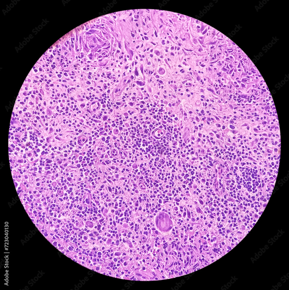 Cold abscess wall (biopsy). Chronic granulomatous inflammation (CGI ...