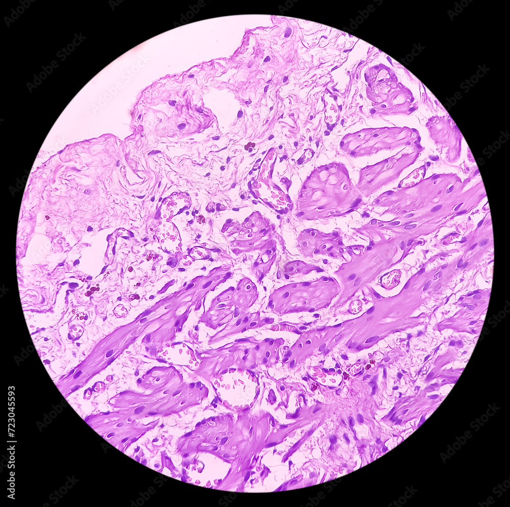 Ovarian cyst: Haemorrhagic cyst. Microscopic show ovarian cyst wall of ...