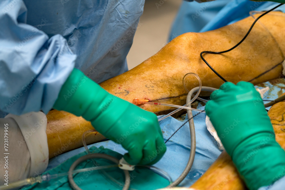 Process of varicose vein surgery in hospital, vein sealing, venous ...
