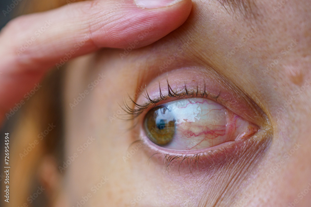 Caucasian Woman's Eye with Symptoms Similar to Pinguecula, Scleritis ...