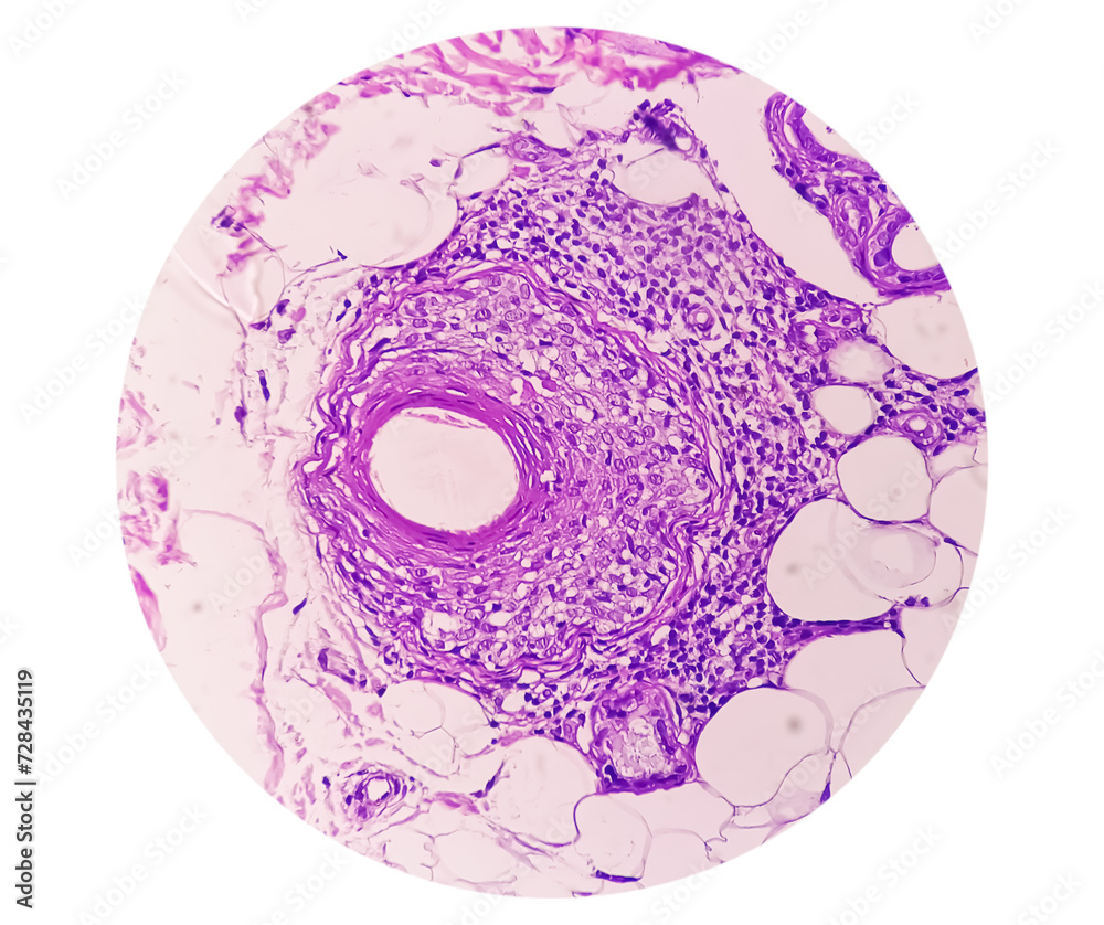Photomicrograph of Skin tissue biopsy showing Lichen planus. T-cell ...