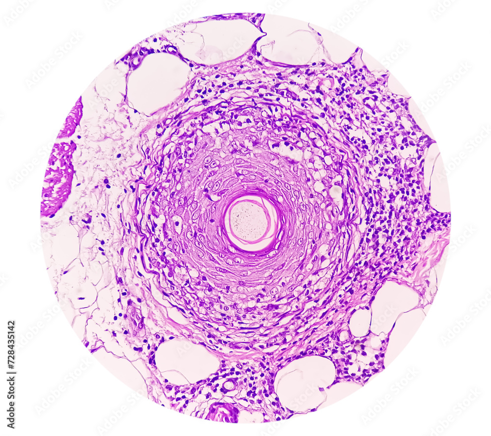 Foto de Stock Photomicrograph of Skin tissue biopsy showing Lichen ...