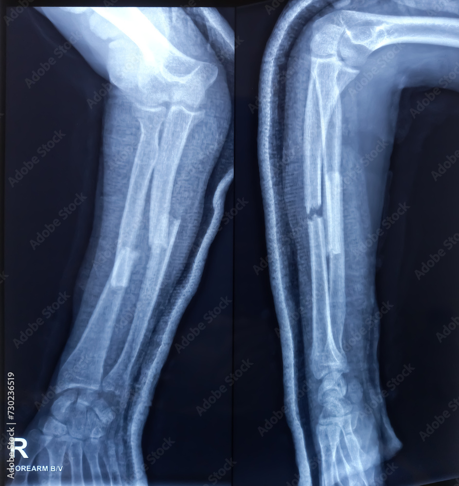Plaster cast obscured the bony details. X-ray image of broken forearm ...