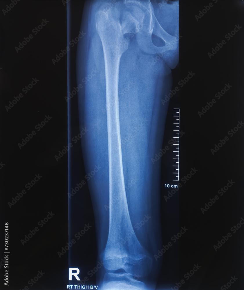 Foto de Stock X-ray film of right Thigh AP view. Fracture is noted at ...