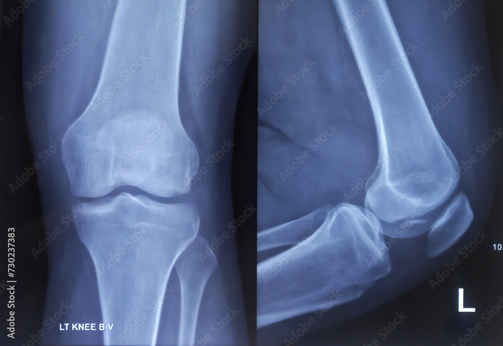 X-ray of knee joint AP and lateral view. Small fracture fragment ...