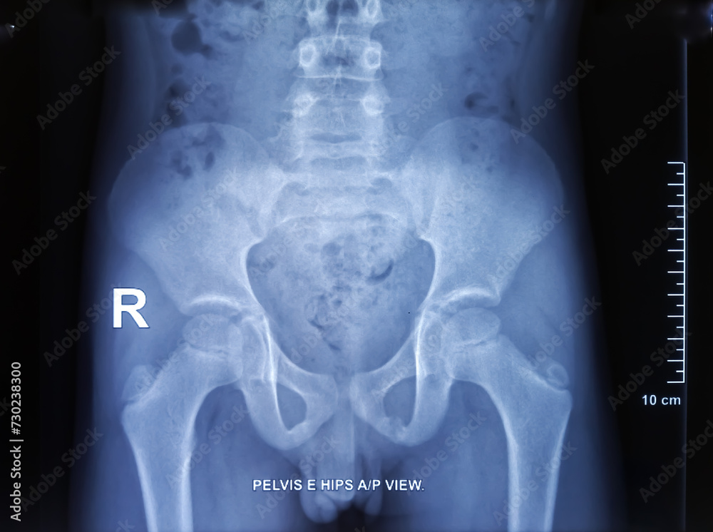 Pelvis x-ray. Film X-ray of Pelvis, hip and SI joint. Fracture is noted ...