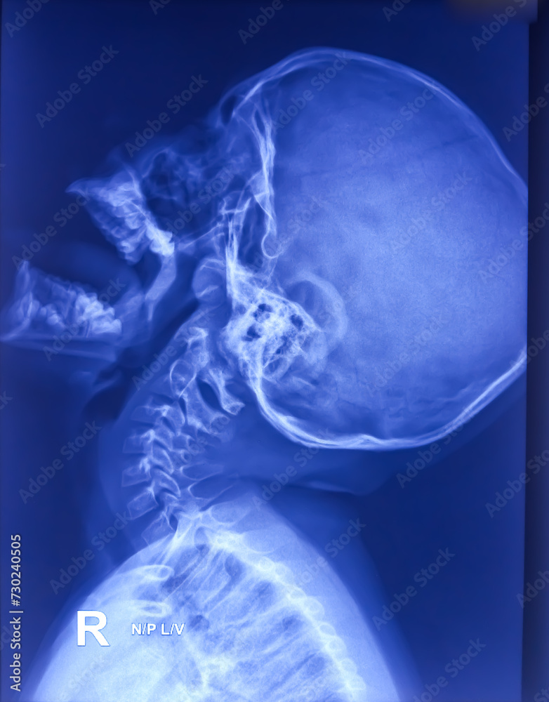 X-ray of nasopharynx lateral view show Enlarged adenoid. Small ...