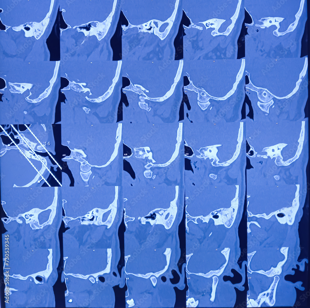 CT scan of the temporal bones showing picture suggestive of bilateral ...